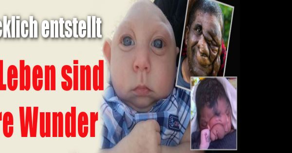 Reggie Bibbs, Lizzie Velasquez, Jaxon Buell: Furchtbar entstellt: Diese ...